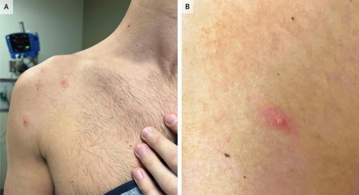 Médica alerta sobre sintomas da varíola dos macacos e a importância da ...