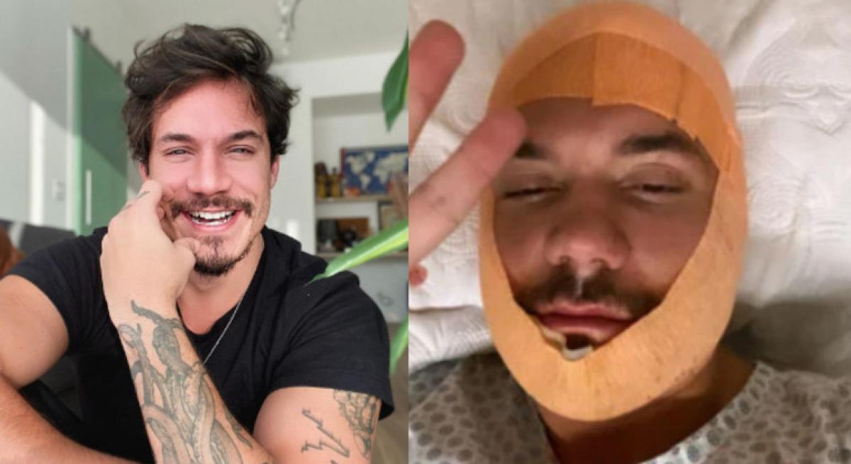 Entenda como é feito o transplante de barba e quais os riscos do ...